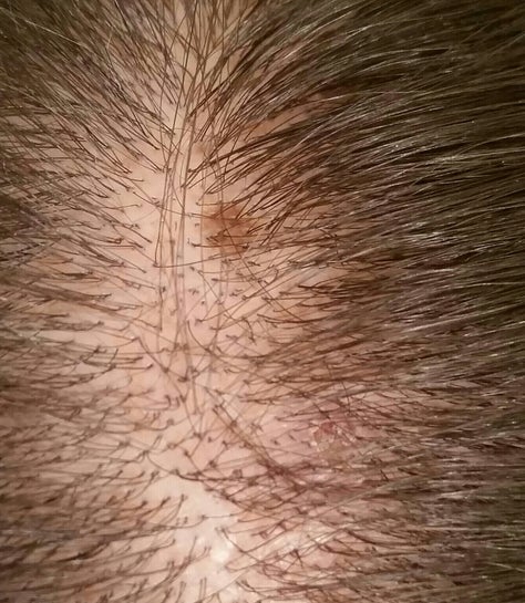 What Are The Brown Crusty Spots On My Scalp - Infoupdate.org
