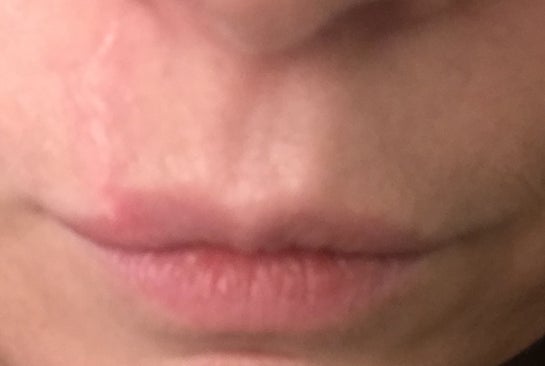 Vermilion Border Scar