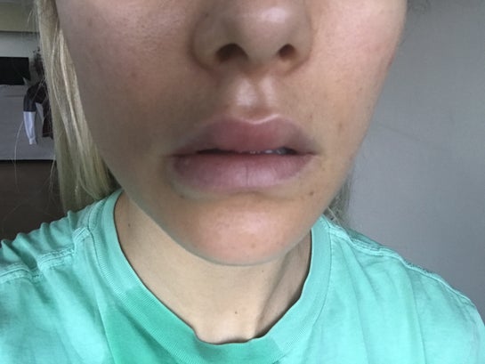 Random Swelling Of Lips | Lipstutorial.org