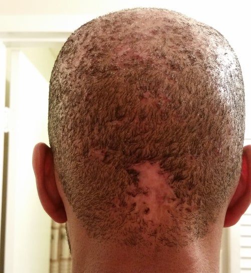 folliculitis decalvans