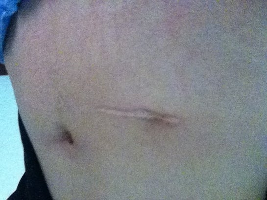 Laparoscopic Appendectomy Scars