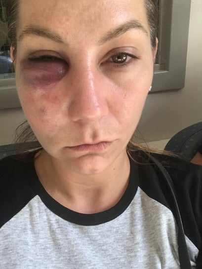 fractured cheekbone bruising