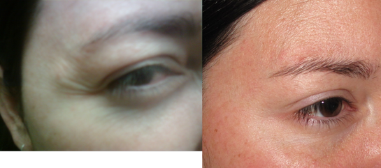 Botox Before & After Pictures - RealSelf