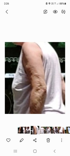 cellulite on upper arms