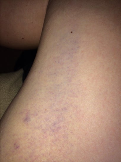 thigh bruises