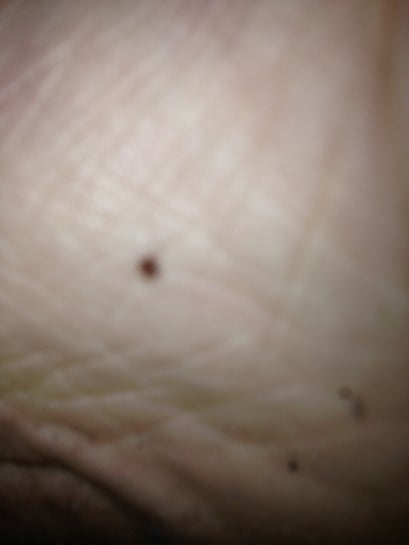 Small Mole On Bottom Of Foot Online | emergencydentistry.com