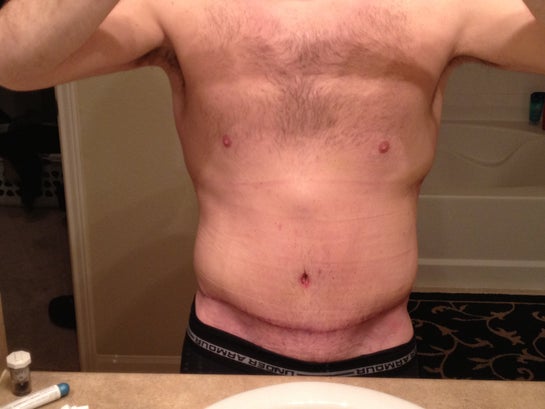 enlarged xiphoid process inflamed