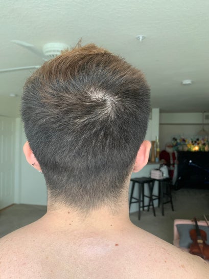 Cowlick Back Of Neck