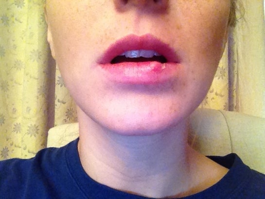 Sebaceous Cysts On Lips | Lipstutorial.org