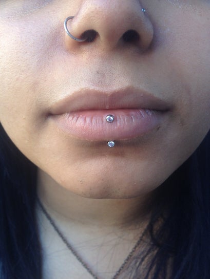 Vertical Labret Infection