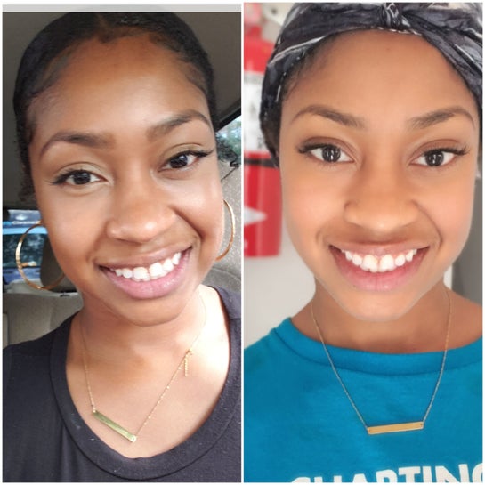 what causes chipmunk cheeks