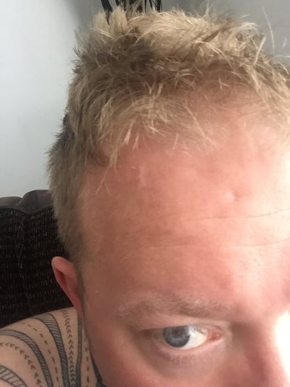 indent in head after hitting it