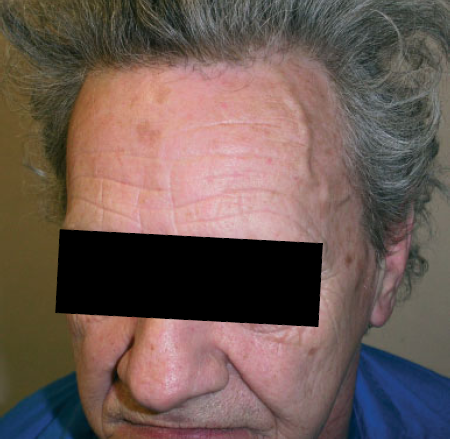 Superficial Temporal Artery Pulse