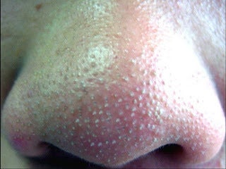 Trichostasis Spinulosa Causes