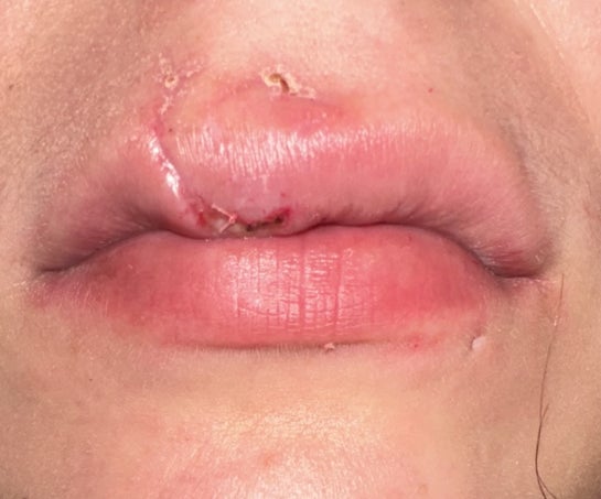 inner lip bite scar