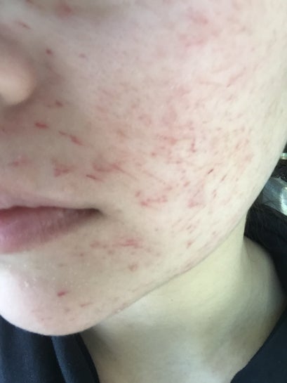 Skin Scratch Marks