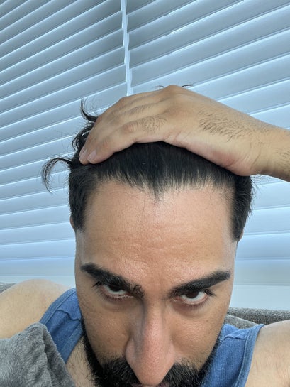 Accutane hair loss store