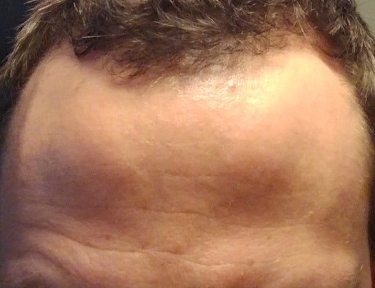 frontal eminence function