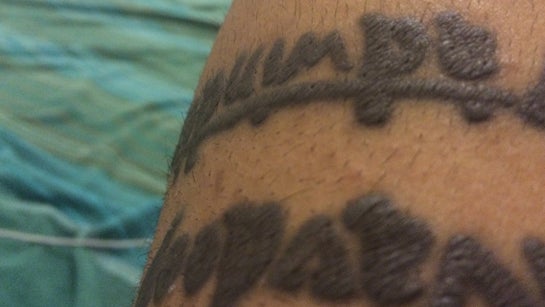 Raised tattoo scar - Bronctattooaus.com