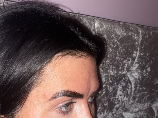 Vertical Line On Eyebrow Measurement Sites On The Eyelid. A, The Blue