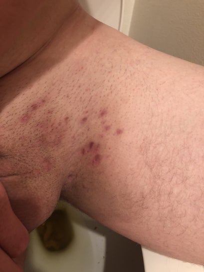 shingles scars itching