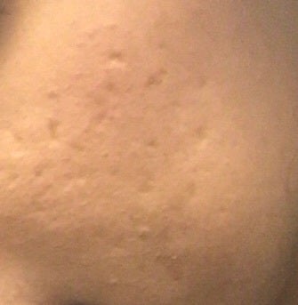 shallow rolling scars