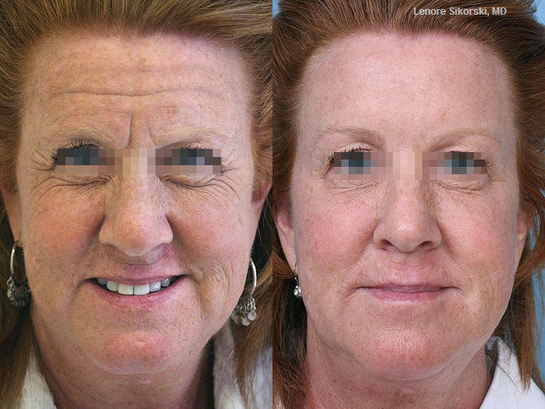 Botox Before & After Pictures - RealSelf