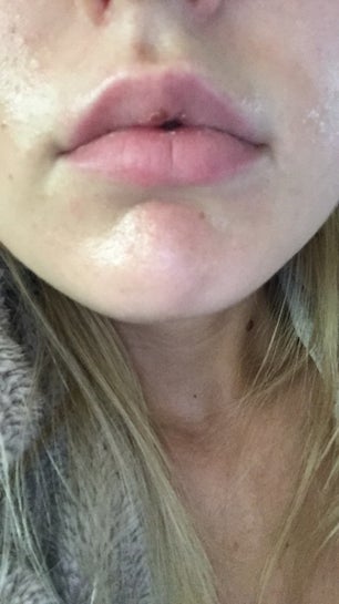 tiny holes on upper lip