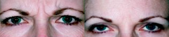 Botox Before & After Pictures - RealSelf