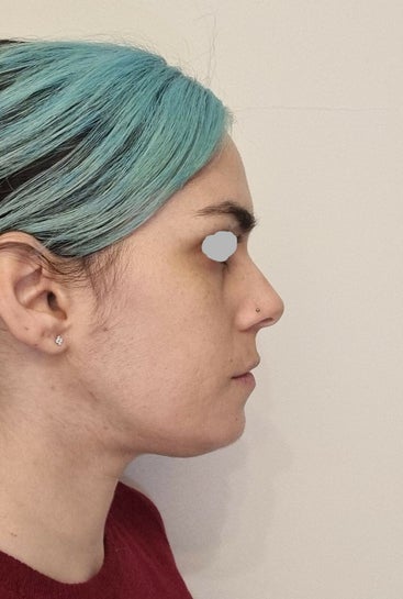 forehead bone shaving