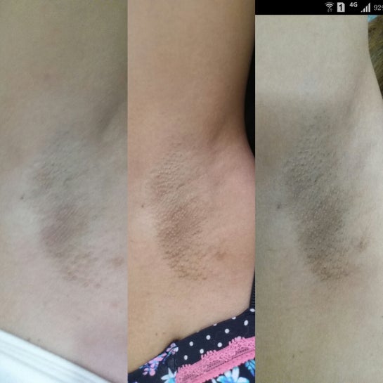 Underarm Ipl Before And After