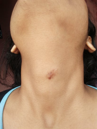 keloid neck