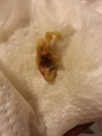 nasal scabs bleeding