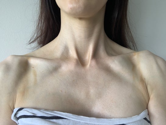 protruding collar bones