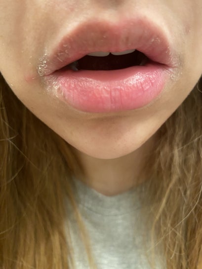 Minor Angular Cheilitis