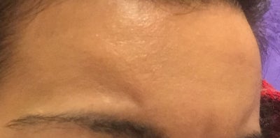 I turned 23 and I have noticed "dents" above my eyebrow. And I also ...