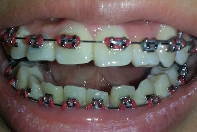 4 years with braces and teeth are still crooked. What do you think ...