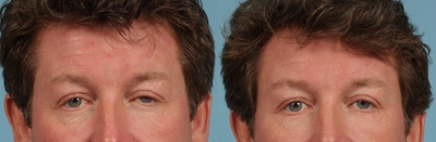 Brow Lift Before & After Pictures - RealSelf