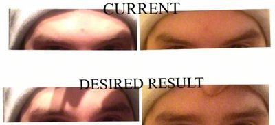 Is a pretrichial brow lift or an endoscopic brow lift a better way to ...