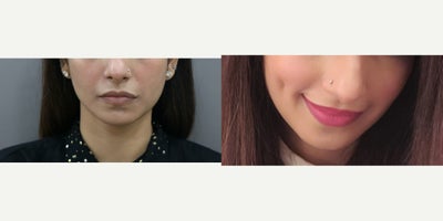 Dimple Surgery Before & After Pictures - RealSelf
