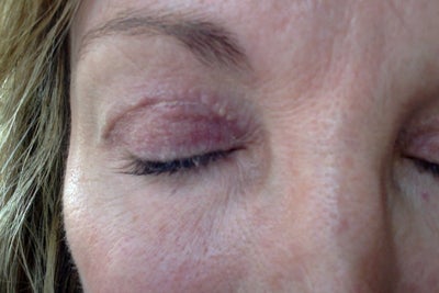 Slow healing incision post upper blepharoplasty. Will these small lumps ...