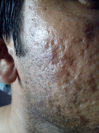 Hard lumps 1 month after subcision (Photo) Doctor Answers, Tips