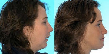 Jaw Surgery Forum & Community Message Board - RealSelf