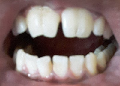 Fused front teeth? (photos) Doctor Answers, Tips