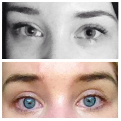 Why have my eyes changed shape? (Photos) Doctor Answers, Tips