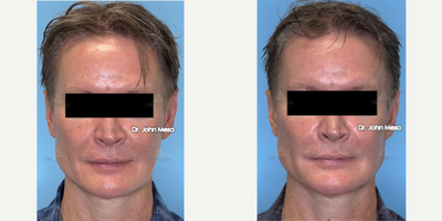 Dermal Fillers Before & After Pictures - RealSelf
