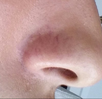 What is the best way to permanently, safely treat telangiectasia (red ...