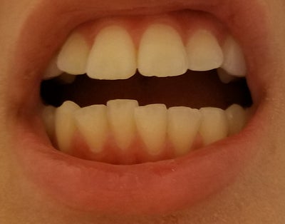 How to fix very protruded/flared angled out teeth to straight reshaped ...