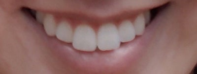How to fix very protruded/flared angled out teeth to straight reshaped ...