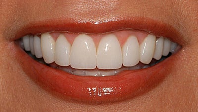 How to fix very protruded/flared angled out teeth to straight reshaped ...